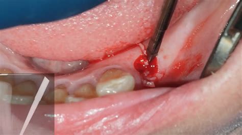 Clinical Video Incorrect Osteotomy Management