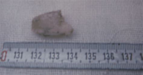 One Fragment Of An Irregularly Multilobulated Mass Tumor Download