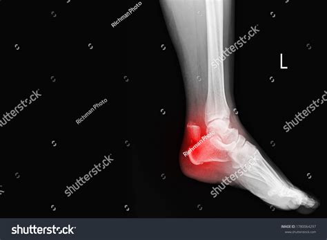X Ray Ankle Dislocation Medworldonline