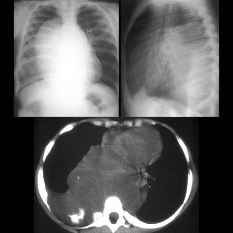 School Ager With A Cough For 1 Month Pediatric Radiology Case