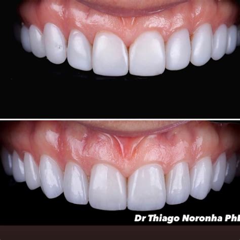 12 Avaliações Sobre Dr Thiago Noronha Phd Ortodontia Invisalign