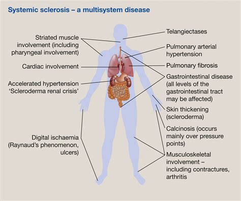 Systemic Sclerosis Gene Activity Predicts Progression Of Autoimmune