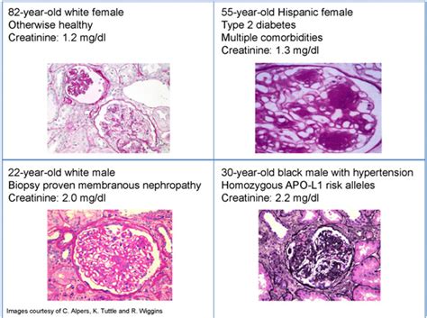 Figure 1 From The Ckd Classification System In The Precision Medicine