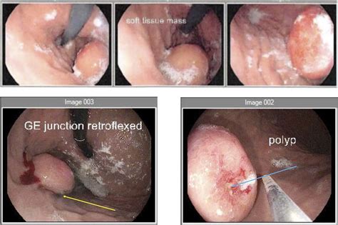 Endoscopy A Gastroscope Showing The GIST On The Posterior Gastric Download Scientific Diagram
