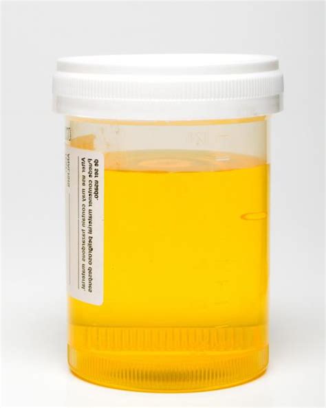 Gonorrhea Urine