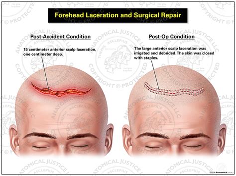 Cpt Laceration Repair Forehead At William Fellows Blog