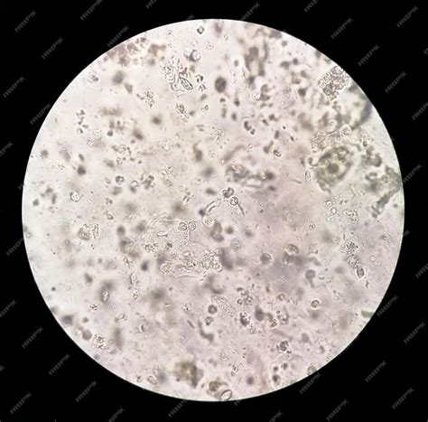 Premium Photo Sputum Smear Without Stain Under Microscopy Showing Pus Cells