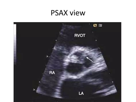 Echo Assessment Of Aortic Regurgitation Pptx