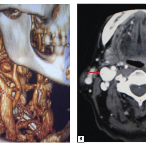 Three Dimensional Computed Tomographic Ct Angiogram A And