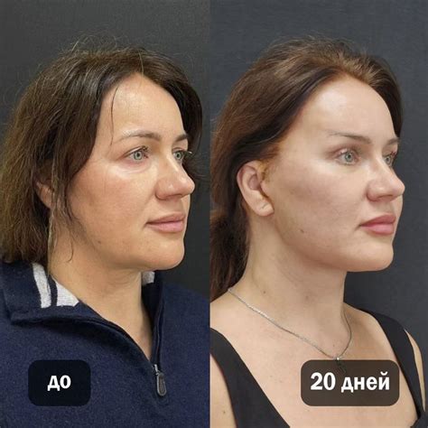 Круговая подтяжка или СМАС лифтинг что выбрать