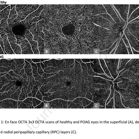 Glaucoma Symptoms Scale Gss Questionnaire Comparison Between