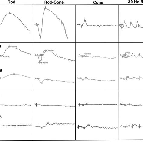 Erg Signals From The Case Examples In Fig 3 The Four Major Iscev