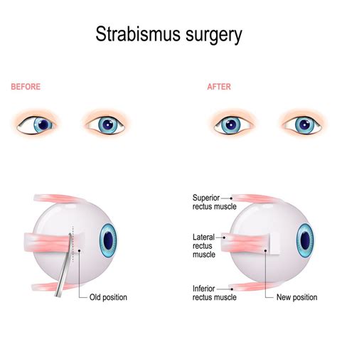Strabismus Surgery Recovery Strabismus Surgery Procedure