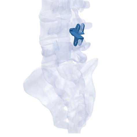 Interspinous Device Octans Online Madison Ortho