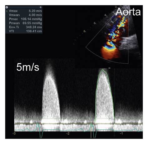 A 43 Year Old Patient With Severe Subaortic Stenosis This Patient Had Download Scientific