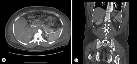 A Ct Abdominal Angiogram Crosssectional View B Ct Abdominal Angiogram