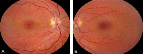 Autofluorescence And Spectral Domain Oct Findings In Alport Retinal Cases And Brief Reports
