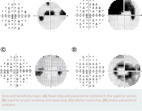 3 print out of four different visual field defects a b download