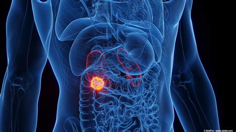 Cabometyx Combo Maintains Progression Free Survival Benefit In Advanced Rcc