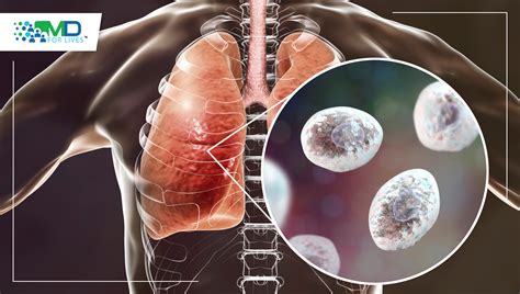 Critical T Cells For Fungal Pneumonia Immunity Study Finds