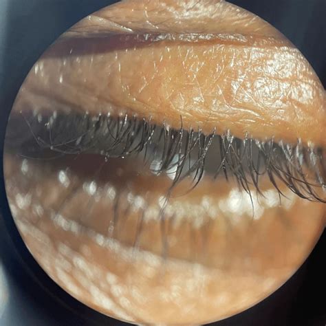 Demodex Blepharitis XDEMVY Lotilaner Ophthalmic Solution 0 25