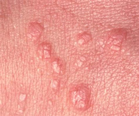 Dermatology Papule Kembara Xtra