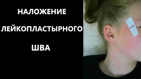Пластырь для стягивания ран - YouTube