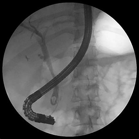 Endoscopic Retrograde Cholangiopancreatography Fluoroscopy Showing A Download Scientific