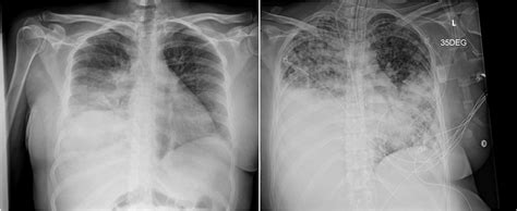 Blastomycosis Infectious Diseases Msd Manual Professional Edition
