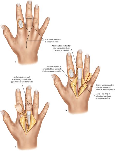 Dorsal Metacarpal Artery Flap Plastic Surgery Key