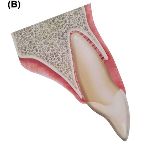 Elian Et Al⁶⁸ Classification Of Alveolar Sockets According To The Download Scientific Diagram