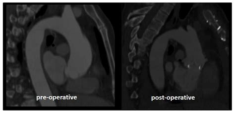 Ascending Aorta Resection And End To End Anastomosis Redistribution Of