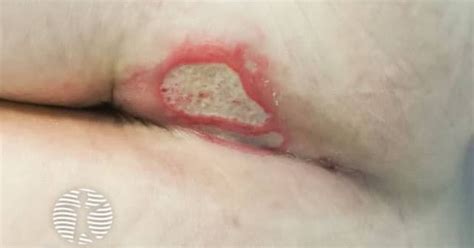 Pyoderma Gangrenosum Image
