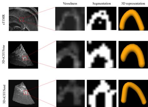 Illustration Of Vascular Structure Segmentation In Ct1mr 3d Iceus