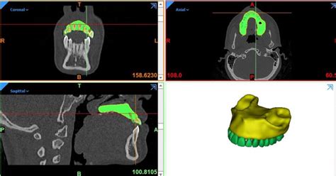 segmentation of bones and teeth in the ct scan volume download