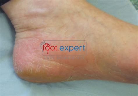 Keratoderma Climactericum Another Cause Of Plantar Hyperkeratosis