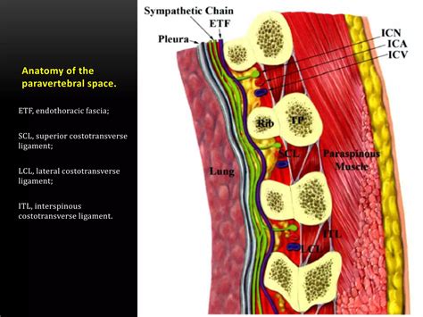 Ultrasound Guided Thoracic Paravertebral Block Pptx