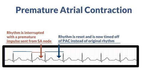 Interpreting Ecg Strips Nursing Unraveled