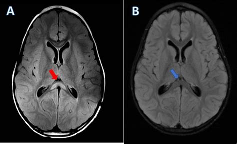 Neuroimaging Demonstrating Splenium Of Corpus Callosum Hyperintensity Download Scientific