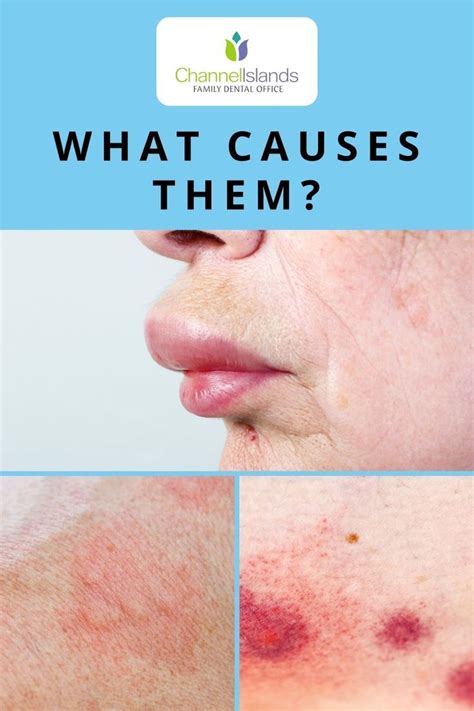 What Are Canker Sores Causes And Useful Treatments Artofit