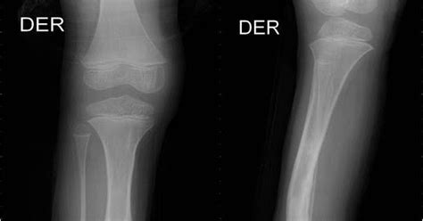 Casimiro Radiactivo Pseudoartrosis CongÉnita De Tibia