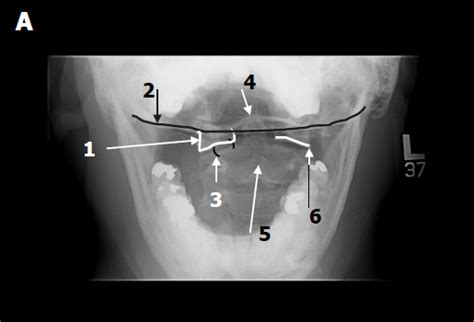 Open Mouth Odontoid Diagram Quizlet