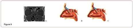 Anatomy Of Frontal Recess And Opening