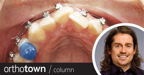 A Voice In The Arena Bite Ramps Part 1 Class 2 Bite Ramps By Dr Chad Foster Orthotown