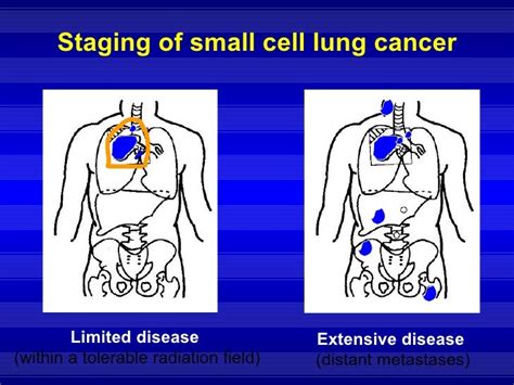 Why Is Small Cell Lung Cancer Inoperable