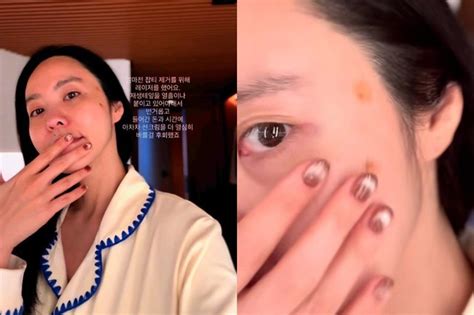 최동석과 이혼 박지윤 속앓이 하다 피부과 시술‥관리못한 과거 후회