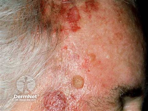 Scalp Tumours And Cysts A Complete Overview Dermnet