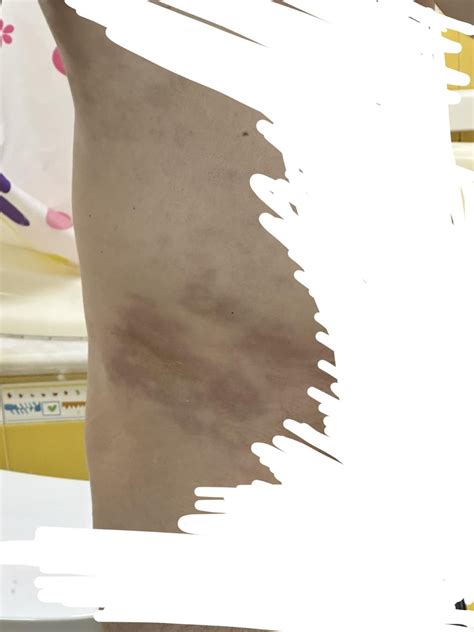 Should I Ask My Doctor About Scleroderma R Scleroderma