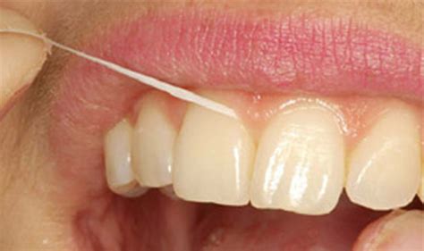Gingivitis Causes Signs Symptoms How To Get Rid Of Gingivitis
