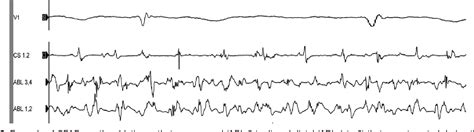 Figure 2 From Atrial Fibrillation Ablation Strategies For Paroxysmal Patients Randomized